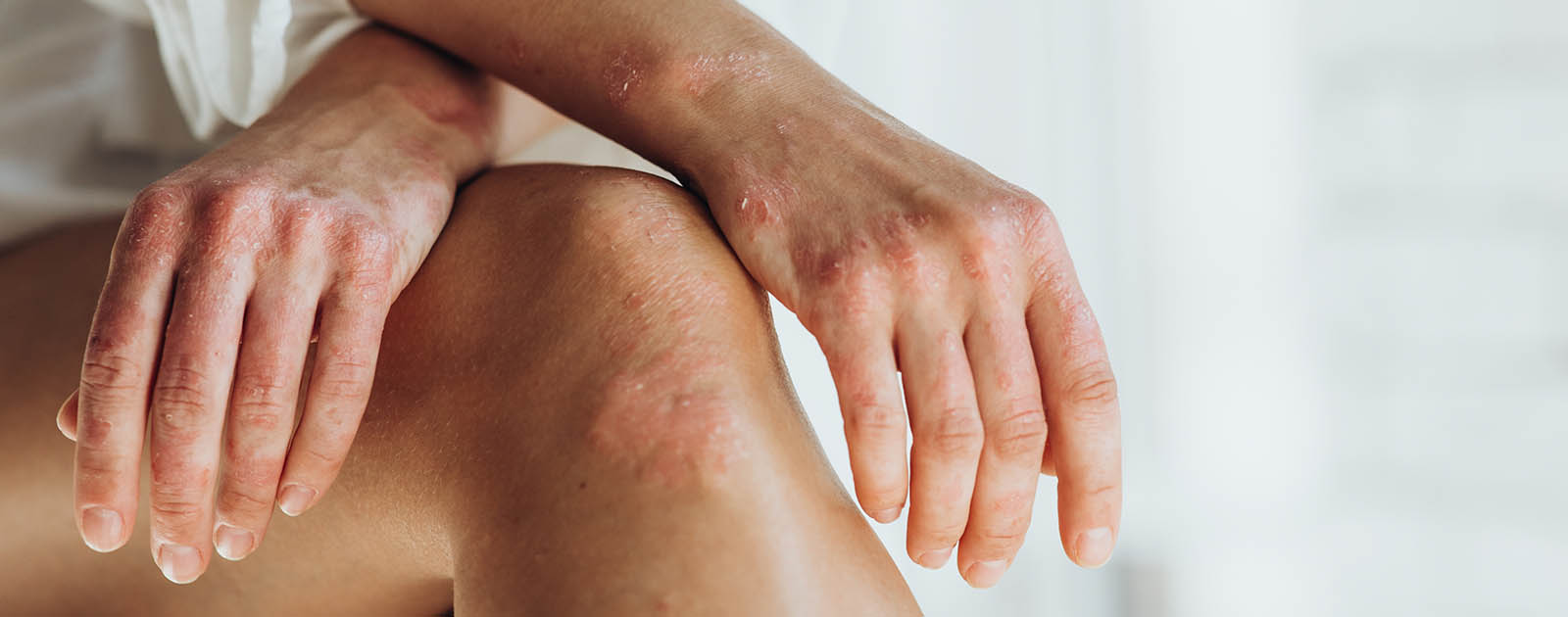 Quais os sintomas da artrite psoriática?