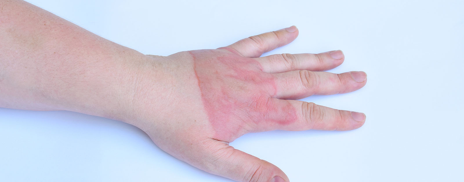 Dermatomiosite: o que causa esta doença inflamatória rara?