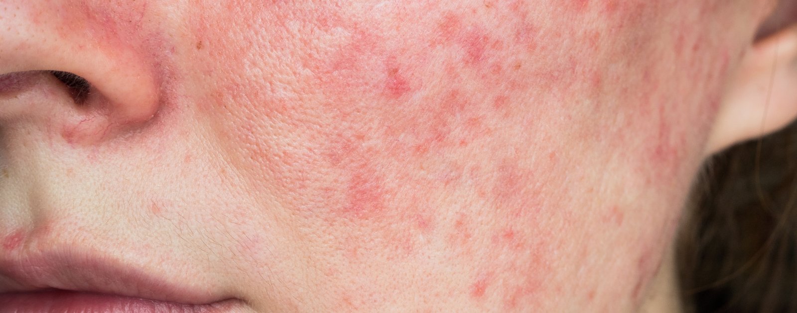 Rosácea: o que é e como controlar os sintomas