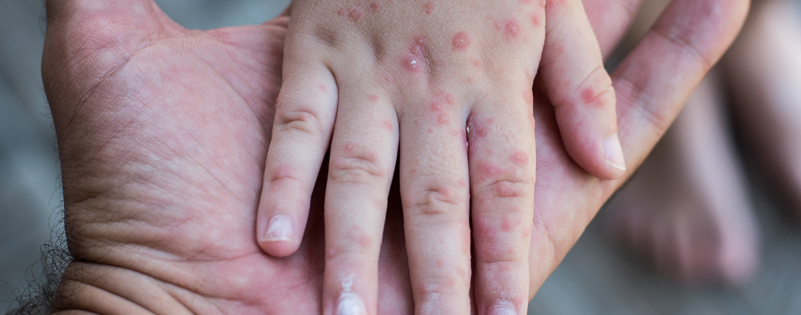 Rubéola: conheça esta doença contagiosa