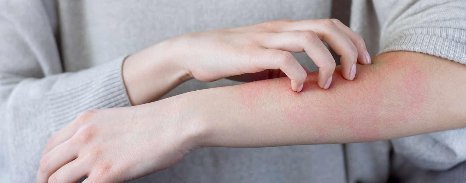 Sarna: como detetar e tratar esta doença de pele