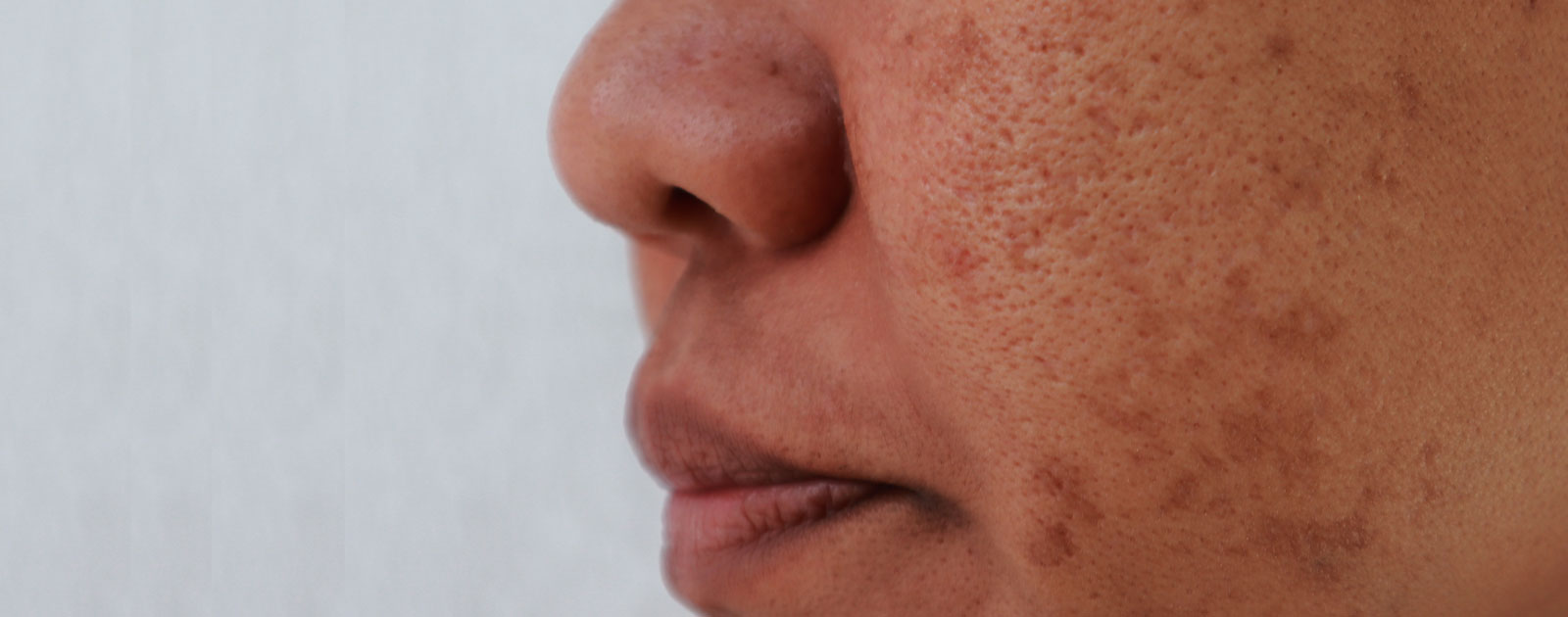 Melasma: em que consiste este problema?