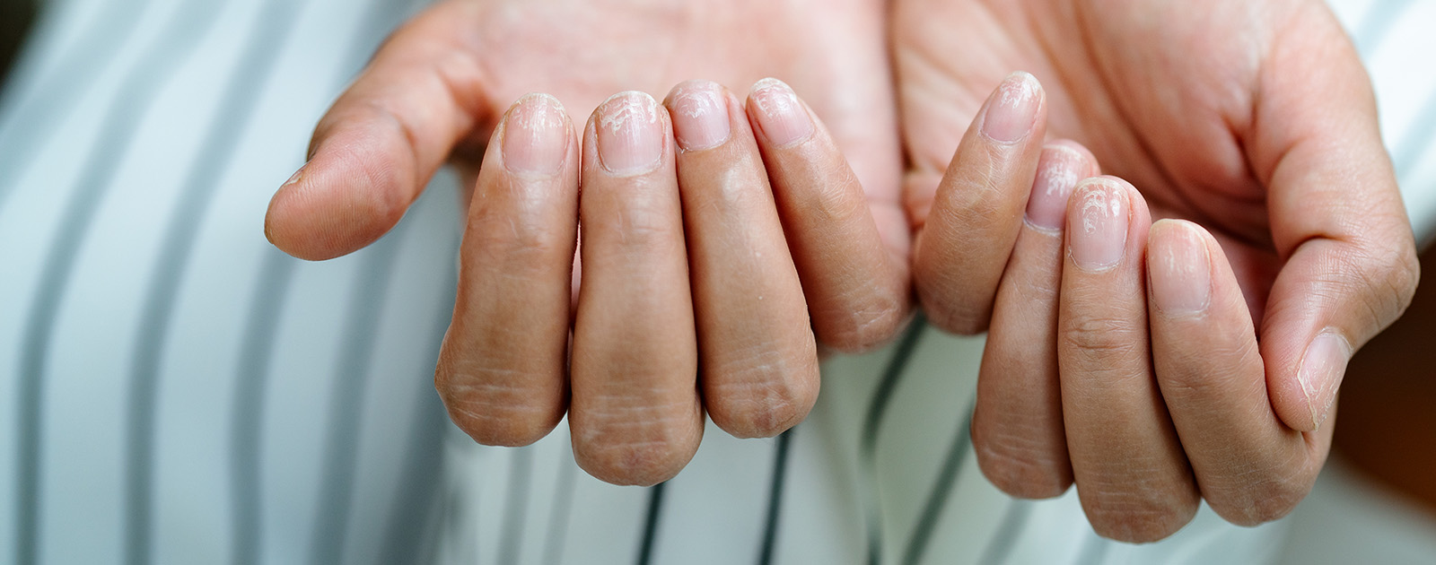 Presta atenção às unhas? Podem revelar muito sobre a sua saúde...